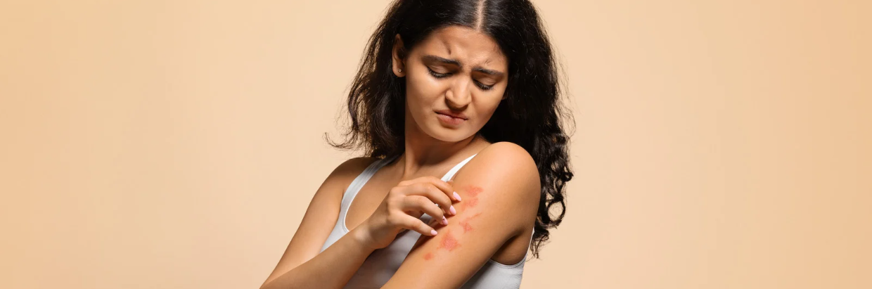 Psoriasis Causes, Symptoms, and Care Tips